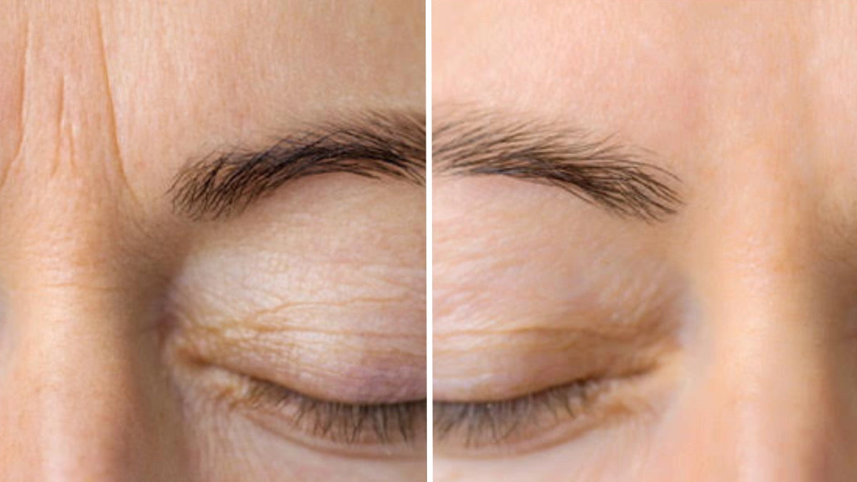 Crème acide hyaluronique avant après application – NOOANCE PARIS